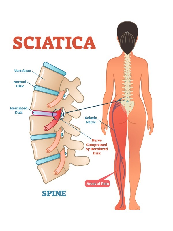 Understanding Sciatica: Causes and Symptoms - Chatfield Family & Sports ChiropracticChatfield ...